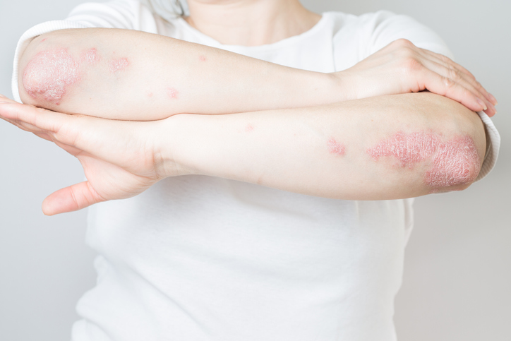 VD 1: FMC 14 : PSORIASIS DE L’ENFANT, quel traitement en 2021 – 365 SFD