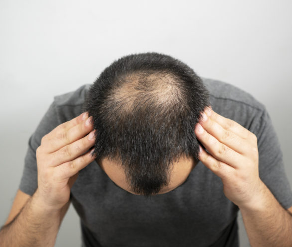 VD 11: FMC 03 : LA PATHOLOGIE DU CUIR CHEVELU, CAS CLINIQUES – 365 SFD